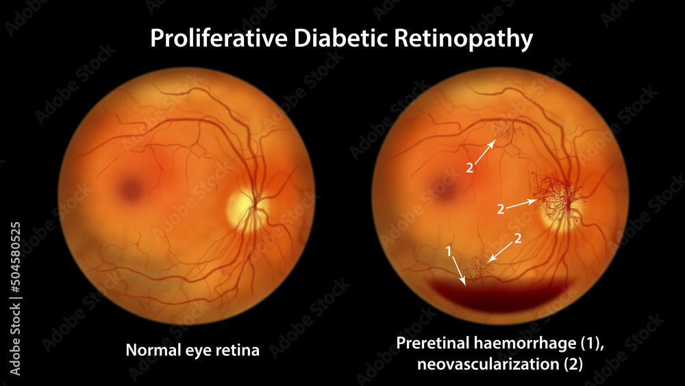 Diabetic retinopathy, ophthalmoscopic diagnosis, illustration Stock ...
