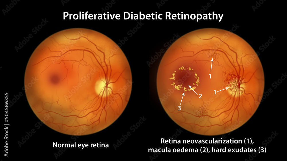 Diabetic retinopathy, ophthalmoscopic diagnosis, illustration Stock ...