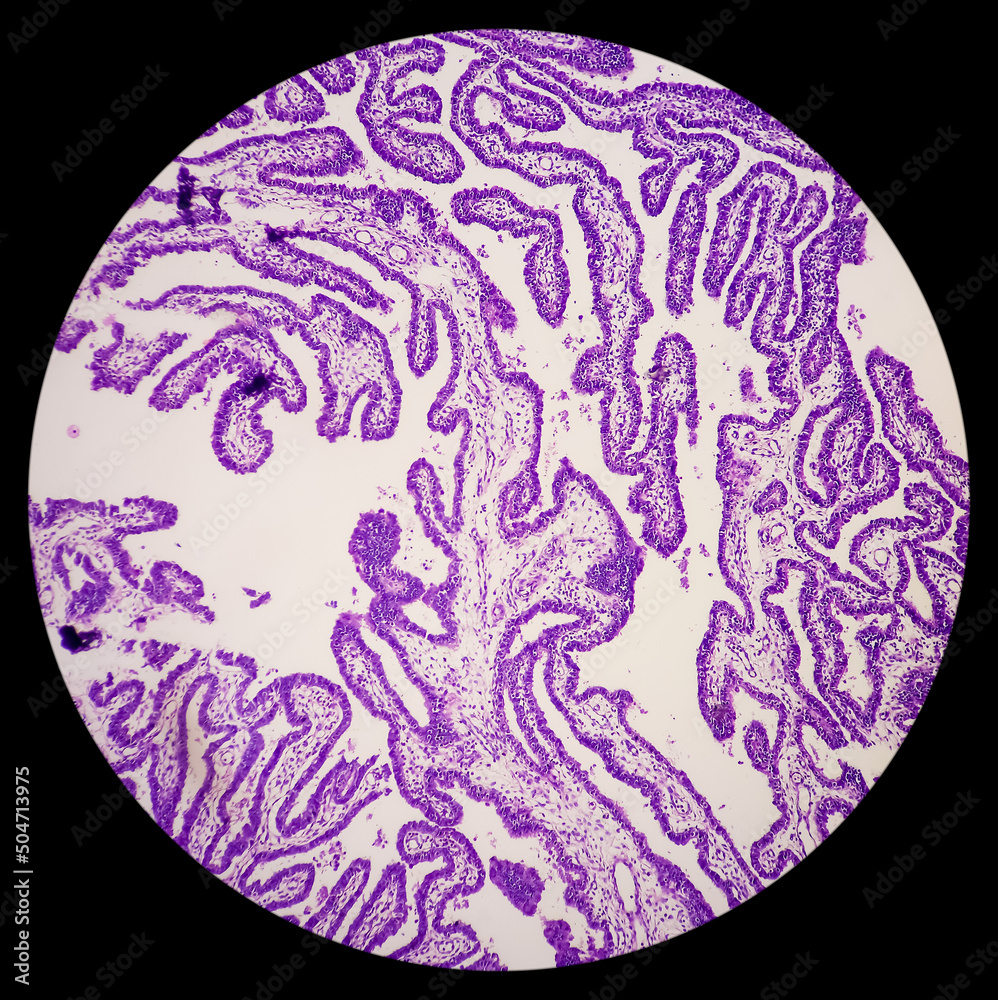 Fallopian tube(biopsy): features of hydrosalpinx(Blocked Fallopian Tube ...
