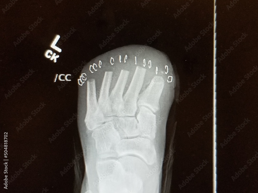 Left foot transmetatarsal amputation with staples - plain x-ray Stock ...