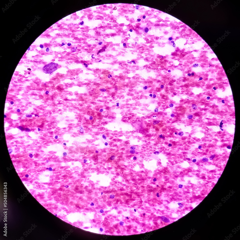 Chronic granulomatous inflammation with tuberculosis, vertebral and ...