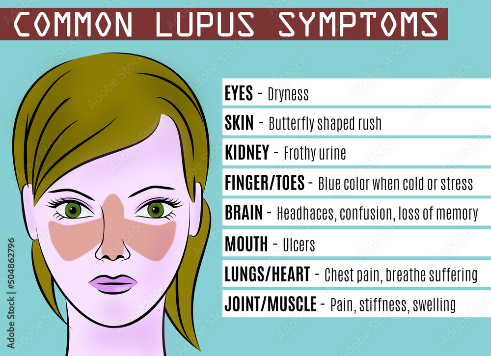 Common lupus symptoms. Illustration of young woman with lupus syndrome ...