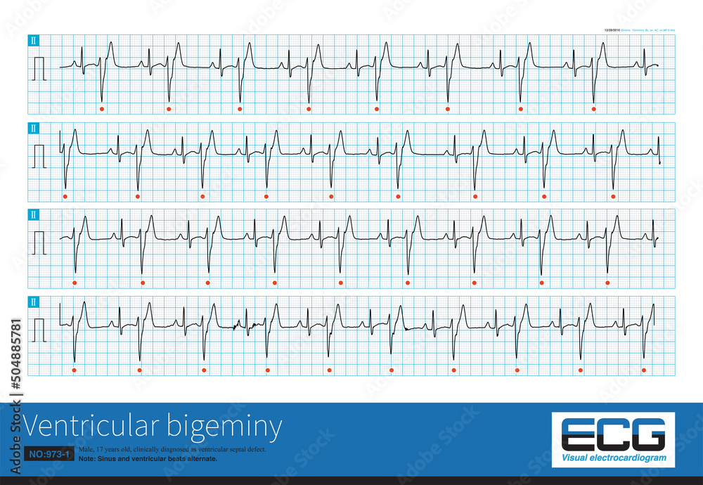 Arrhythmia Background Cardiac Cardiac Arrest Cardiogram Cardiology