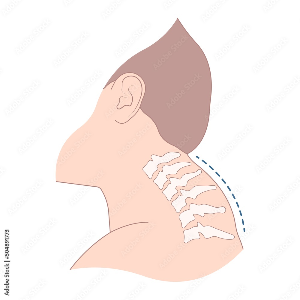 Vektorová grafika „buffalo dowager's hump head bad poor women spine pad ...