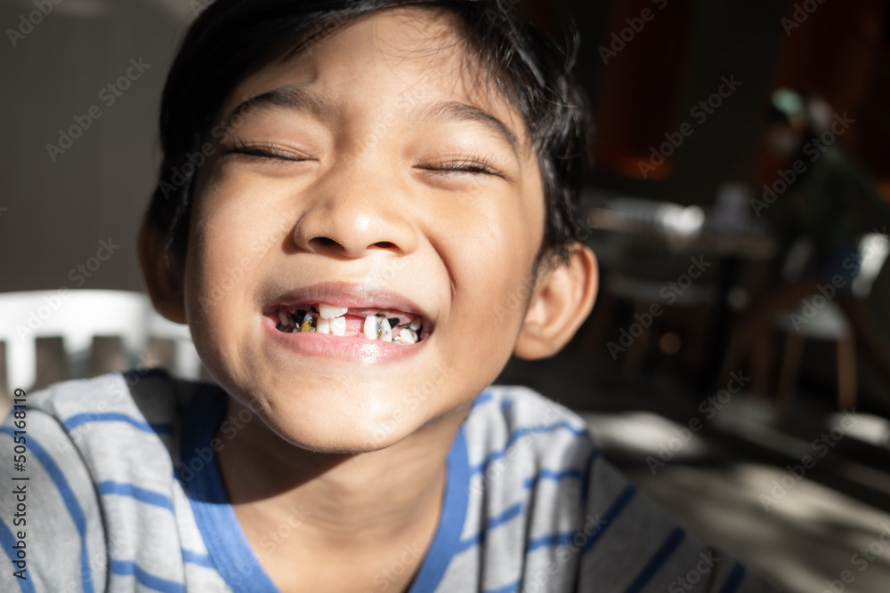 Little Southeast Asian boy with dental problems smiling showing his ...