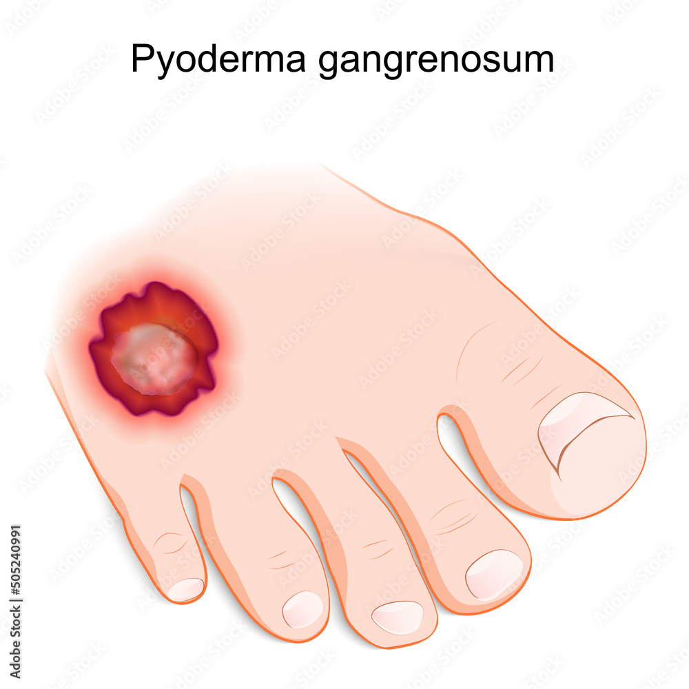 Pyoderma gangrenosum. inflammatory skin disease Stock Vector | Adobe Stock