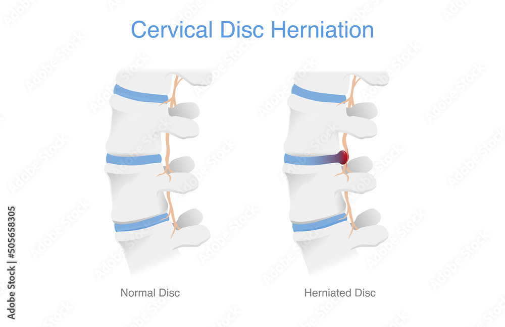 Comparing normal cervical disc and disc herniated of the patient ...
