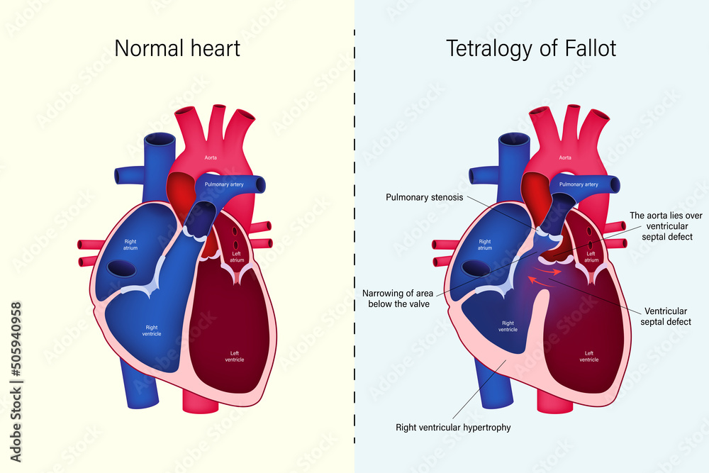 Vetor de The difference of Normal heart and Tetralogy of Fallot vector. Congenital heart disease ...
