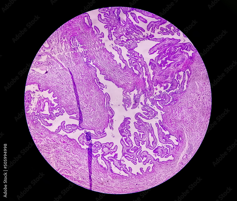 Microscopic image or photomicrograph of Fallopian tube biopsy. Stock ...