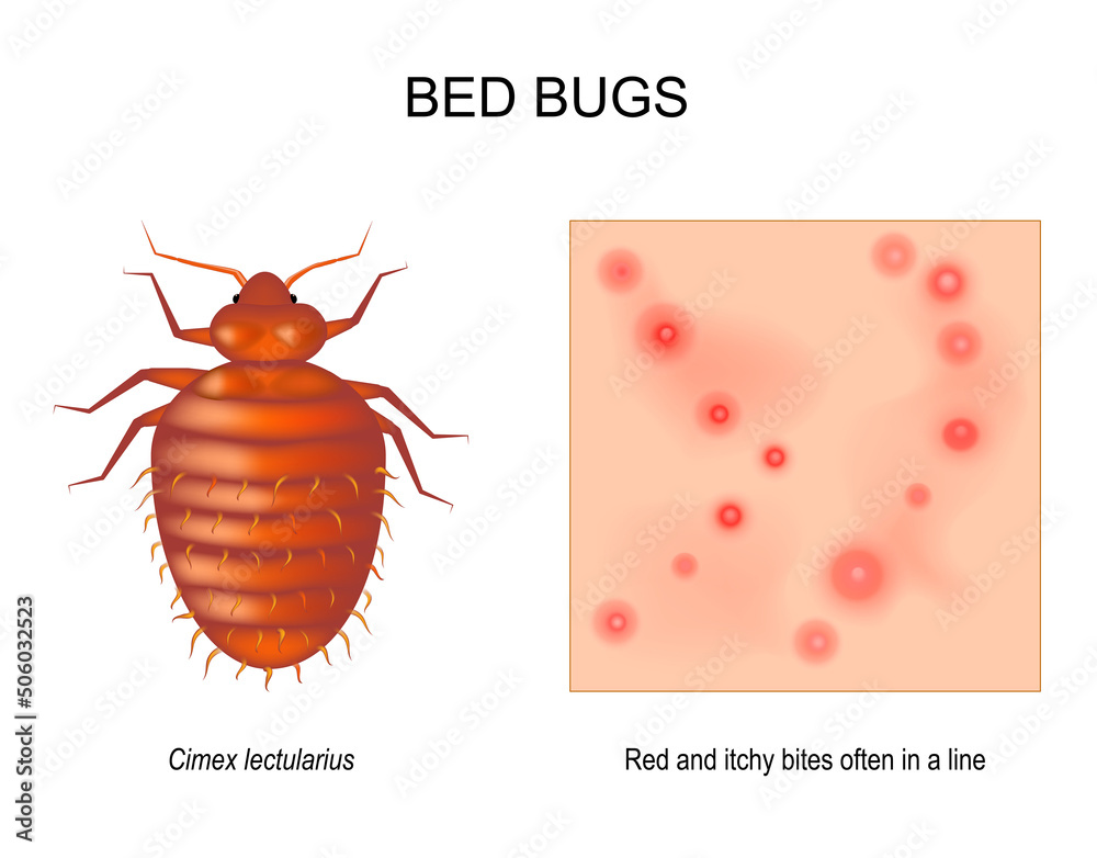 bed bug. Close-up of skin with Red and itchy bites Stock Vector | Adobe ...