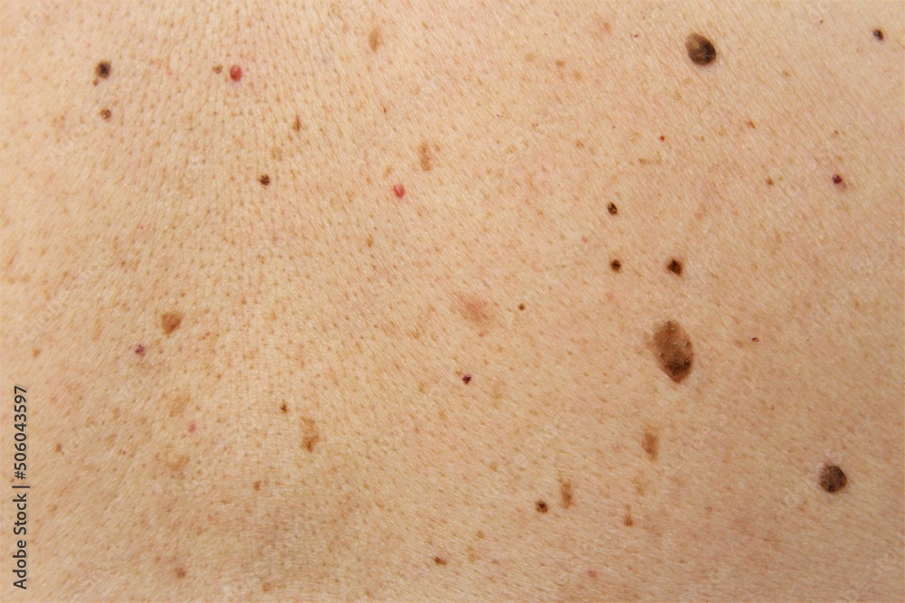 Moles and birthmark on human skin texture. photo horizontal full frame ...
