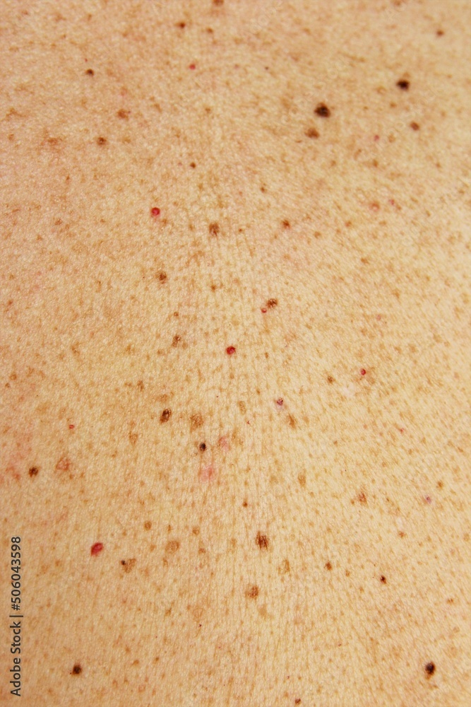 Moles and birthmark on human skin texture. photo vertical full frame ...