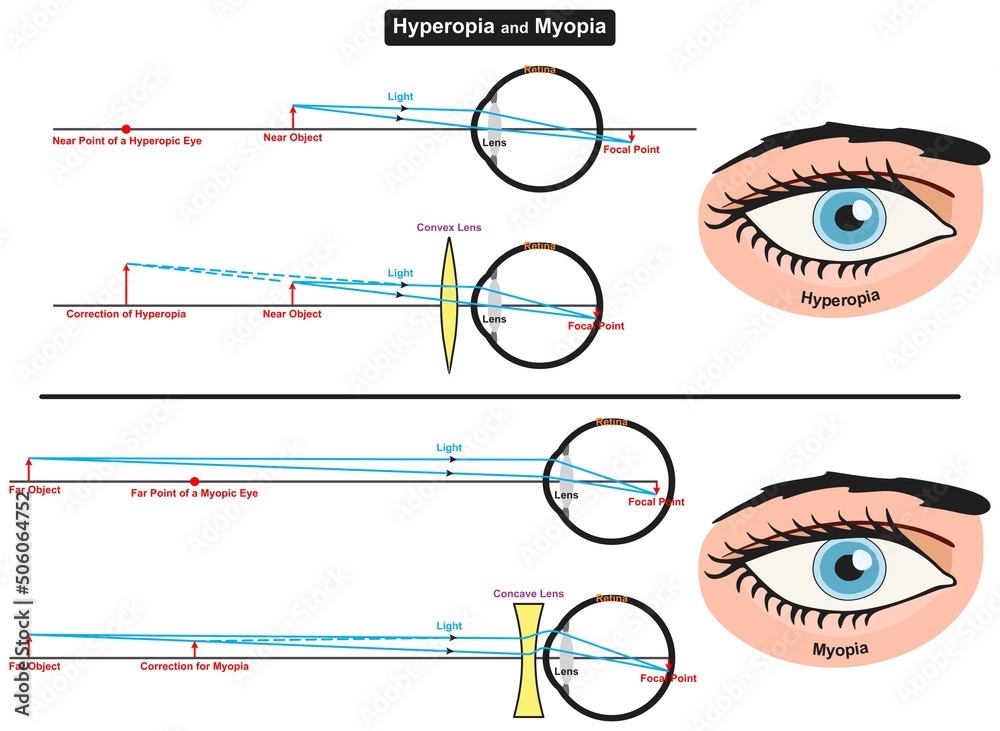 Hyperopia and myopia human eye disease infographic diagram medical ...
