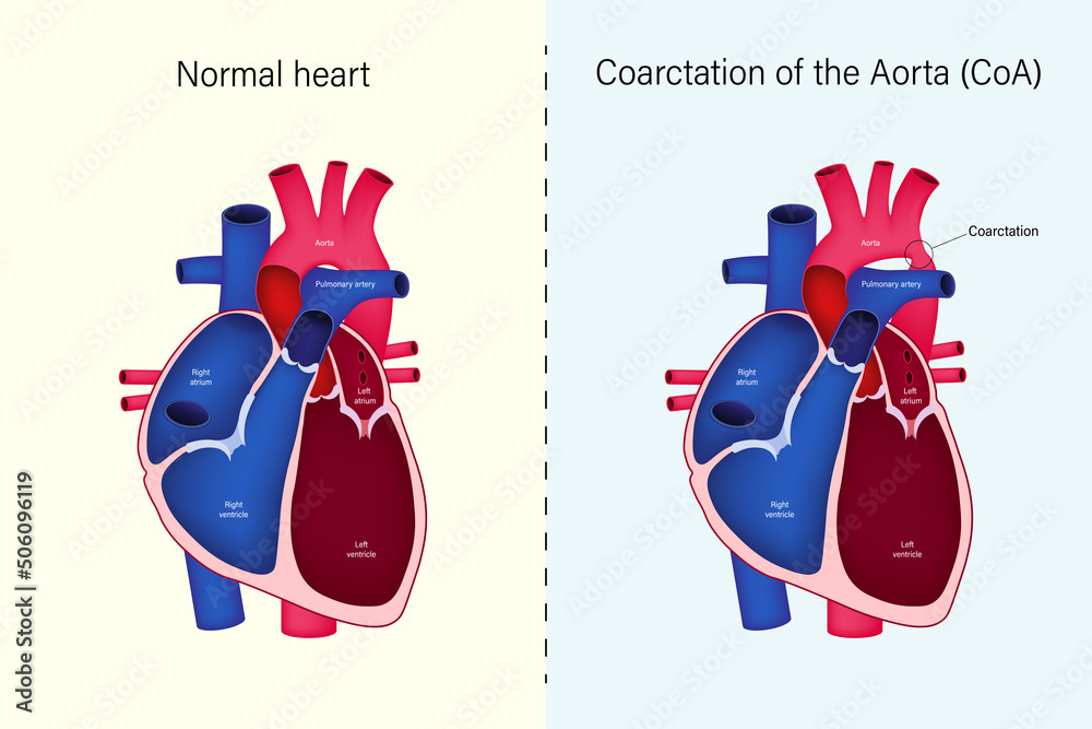 The difference of Normal heart and Coarctation of the Aorta vector ...
