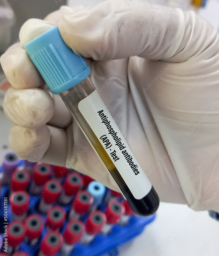 Blood sample tube for Antiphospholipid antibodies(APA) test. To ...