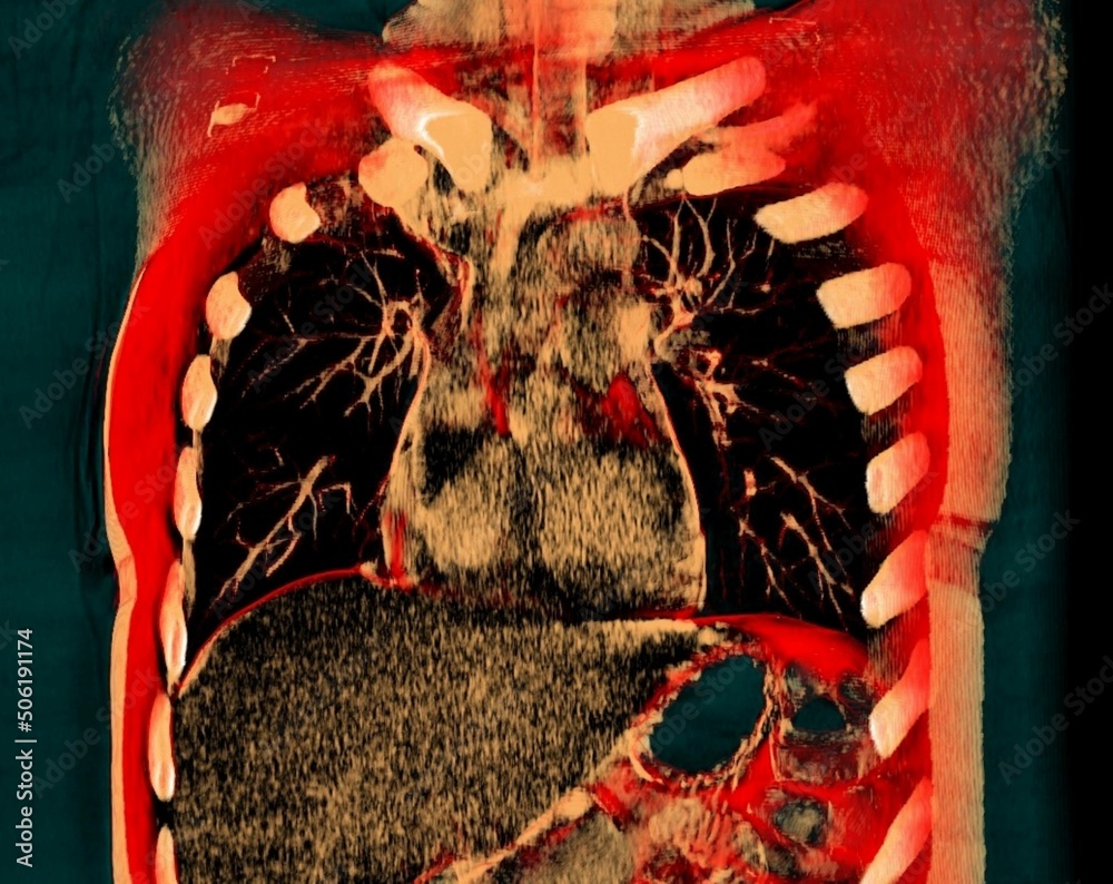Colored 3d chest ct scan showing heart,lung, vascular, liver, and bowel ...