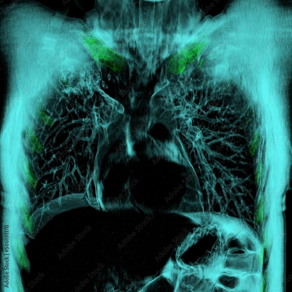 Colored 3d chest ct scan showing heart,lung, vascular, liver, and bowel ...