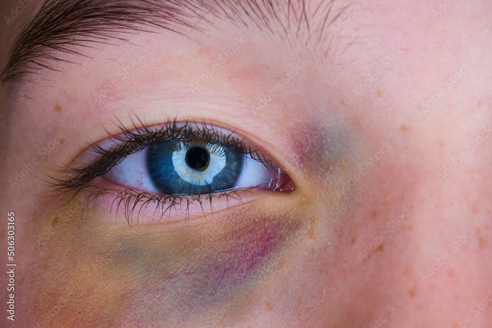 Closeup of sad eye of a child girl domestic violence victim. A blue eye ...