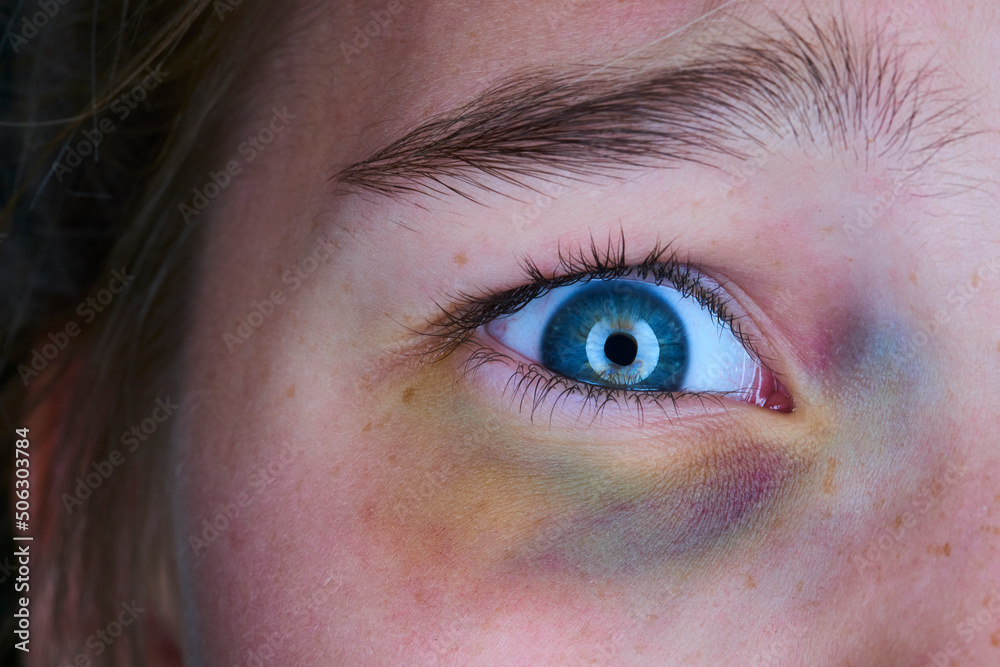 Foto de Closeup of sad eye of a child girl domestic violence victim. A ...