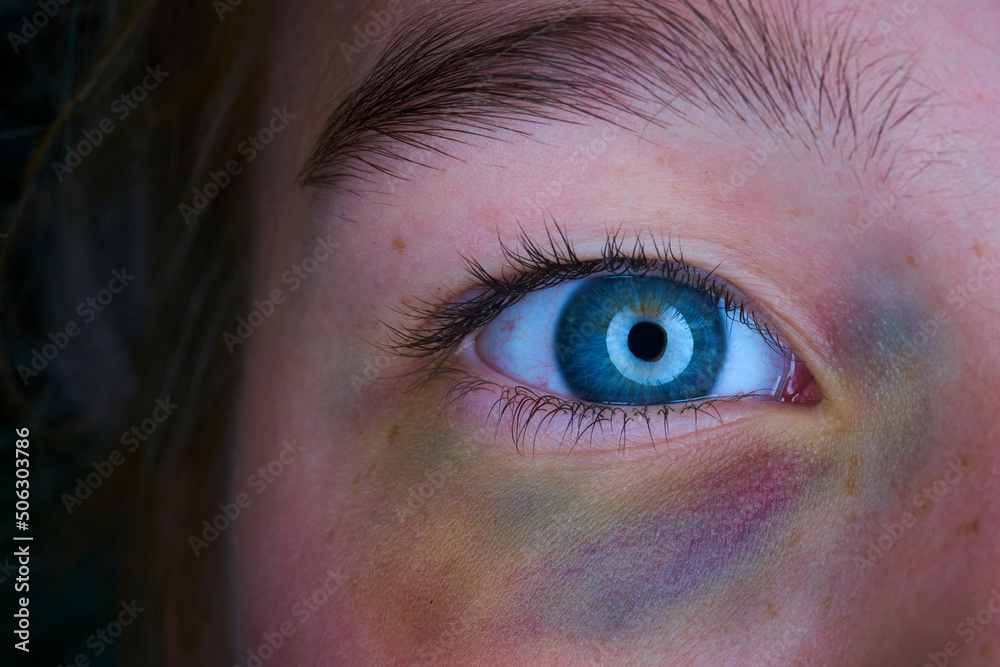 Closeup of sad eye of a child girl domestic violence victim. A blue eye ...