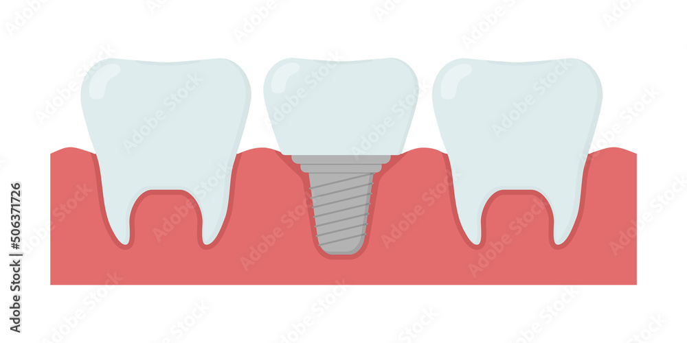 Cartoon healthy teeth and dental implant. Template for stomatology or ...