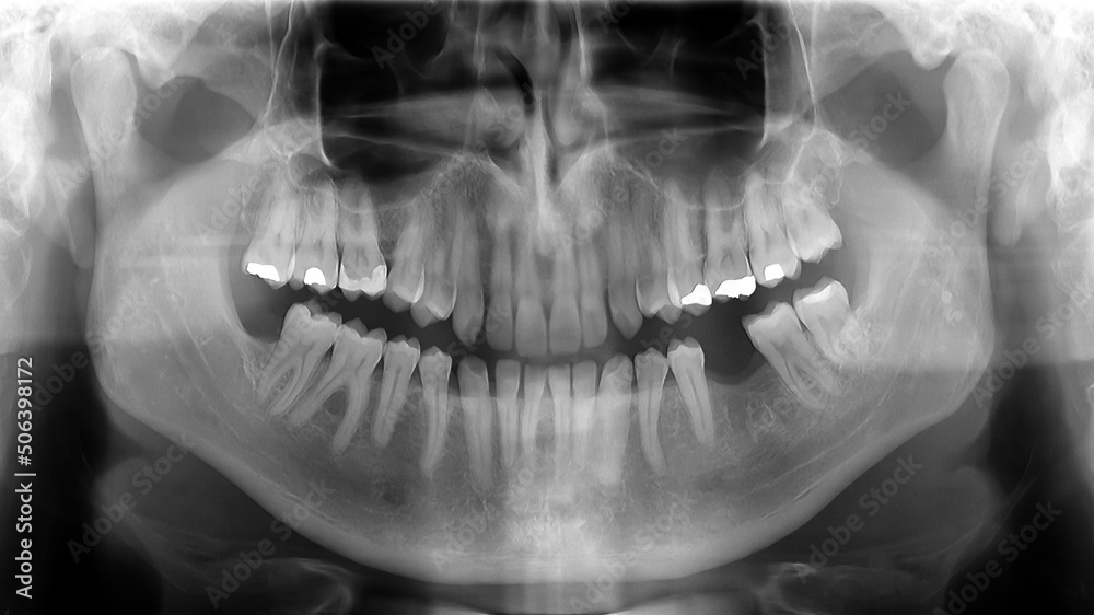 Panoramic x-ray radiograph showing teeth in a human jaw Stock Photo ...