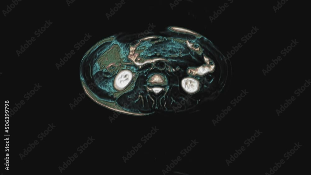 Bulk multicolored CT scan of the abdomen. Computed tomography of the ...