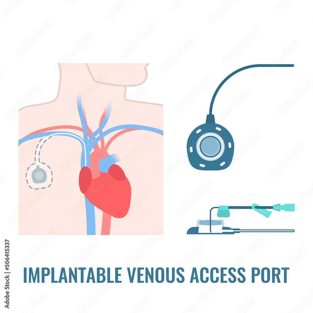 Poster Implantable venous access port on male body – Wall Art | UkPosters