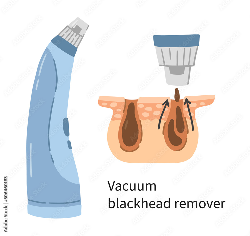 Vacuum blackhead remover vector illustration with layers of dermis and ...