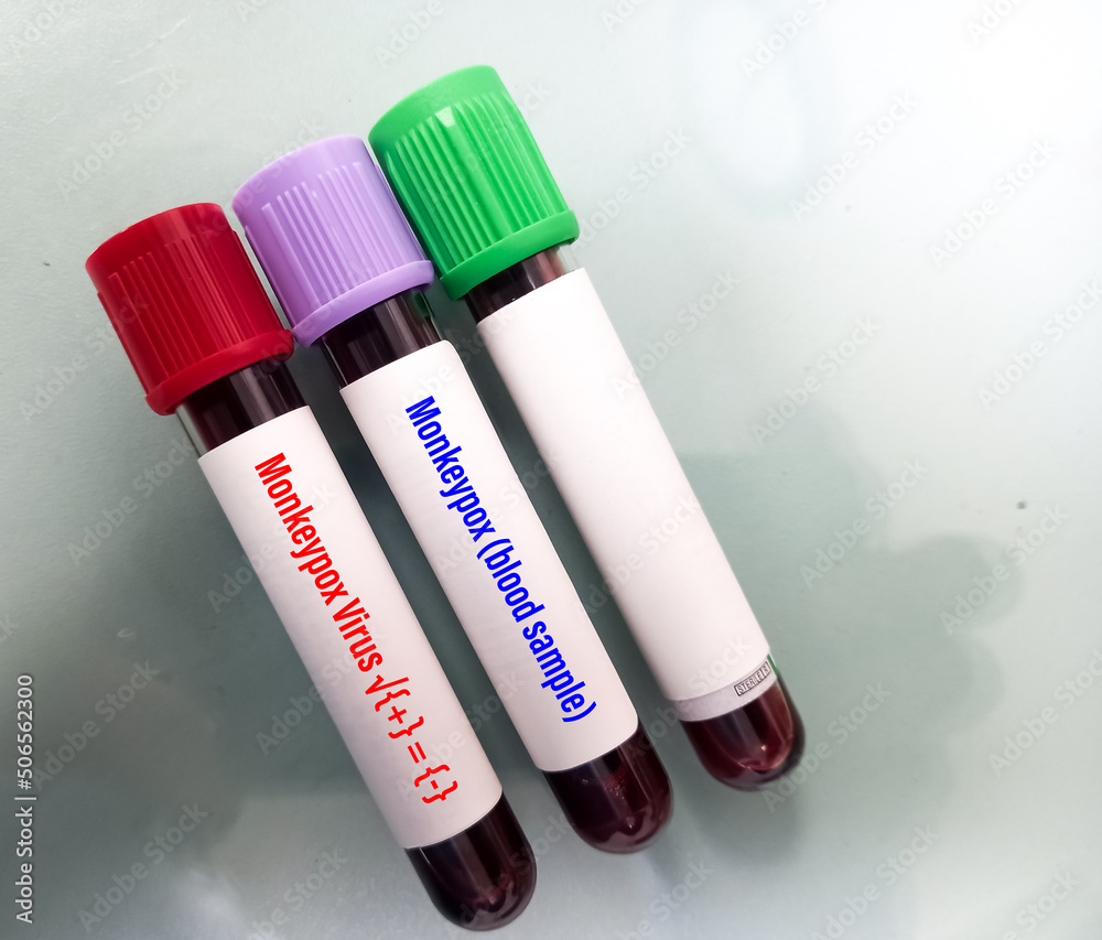 Blood sample tube for Monkeypox virus test. It is a double-stranded DNA ...