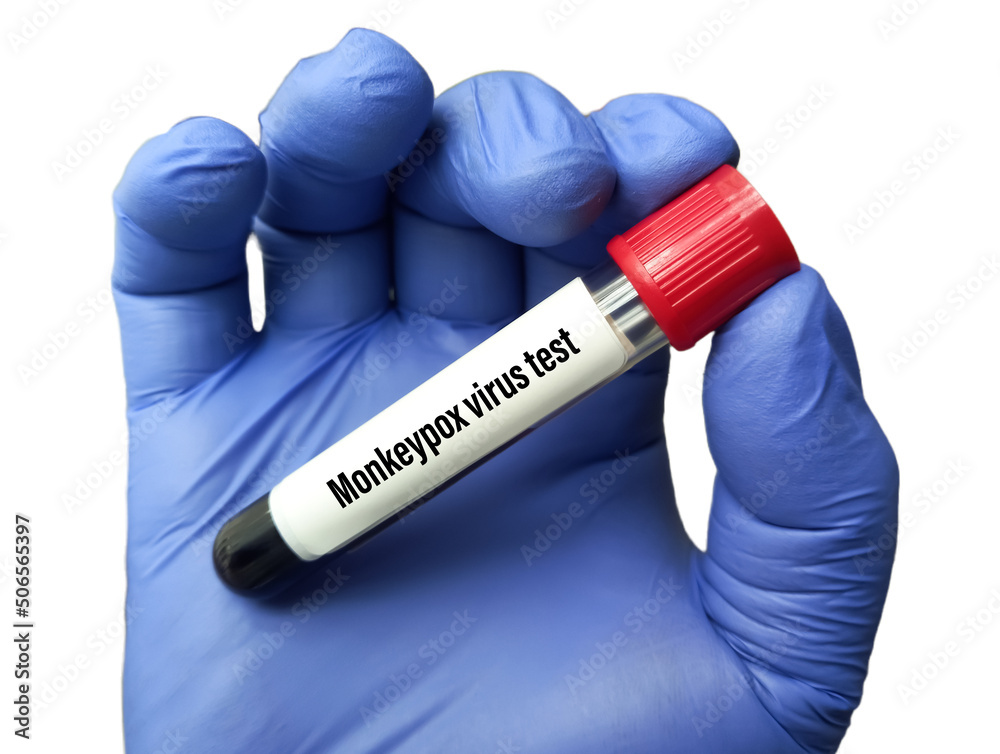 Blood sample tube for Monkeypox virus test. It is also known as the ...