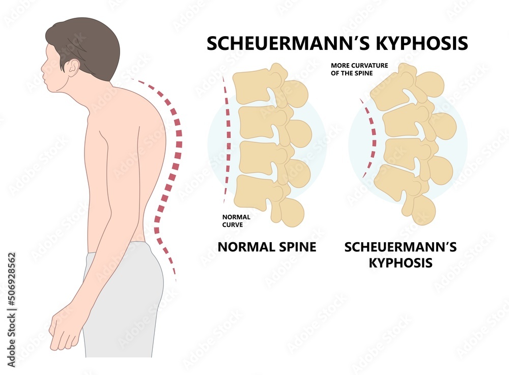 spine forward head posture chest xray neck pain lumbar Scheuermann's ...