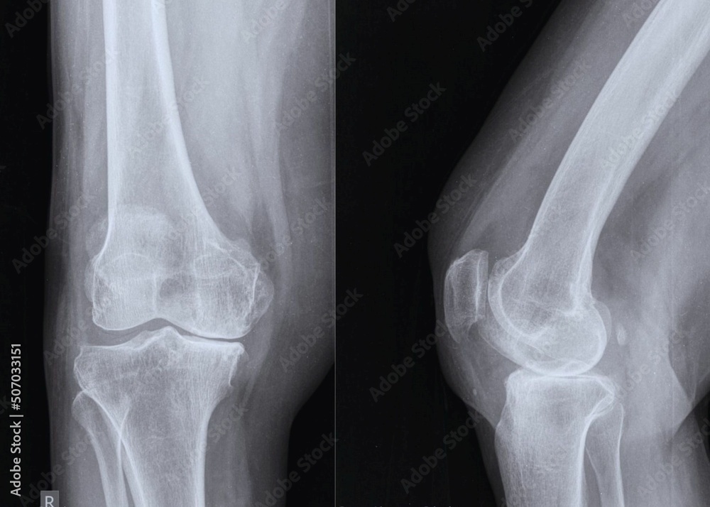 Osteoarthritis knee. show narrow joint space, osteophyte ( spur ...