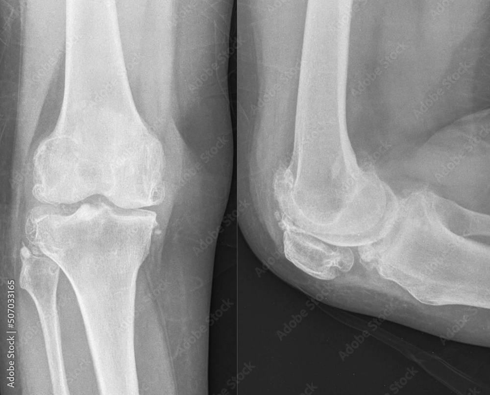 Osteoarthritis knee. show narrow joint space, osteophyte ( spur ...