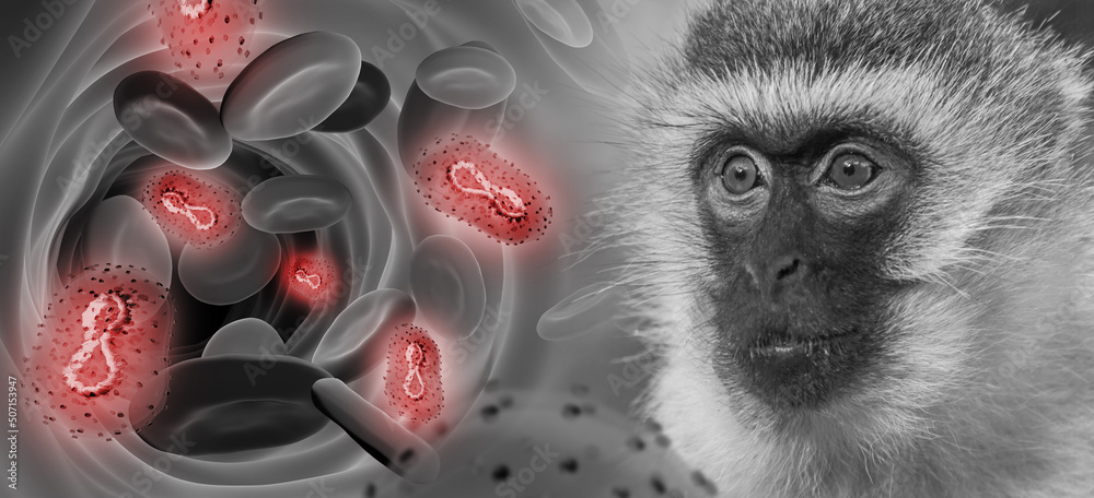 Monkeypox outbreak concept. Monkeypox is a viral zoonotic disease ...