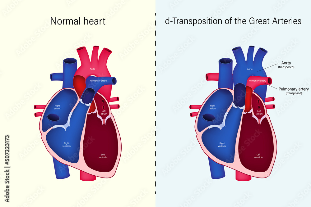 The difference of Normal heart and d-Transposition of the Great ...