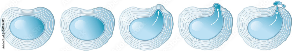 Herniated disc schema. Normal disc. Bulge. Protusion. Extrusion ...