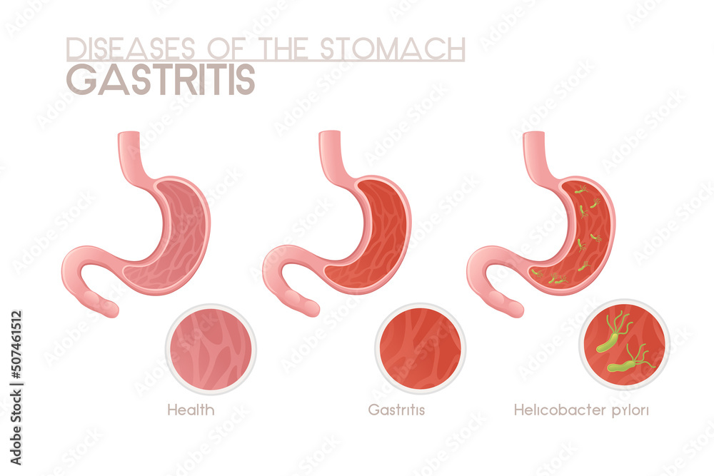 Human Stomach with helicobacter pylori and gastritis cartoon design ...