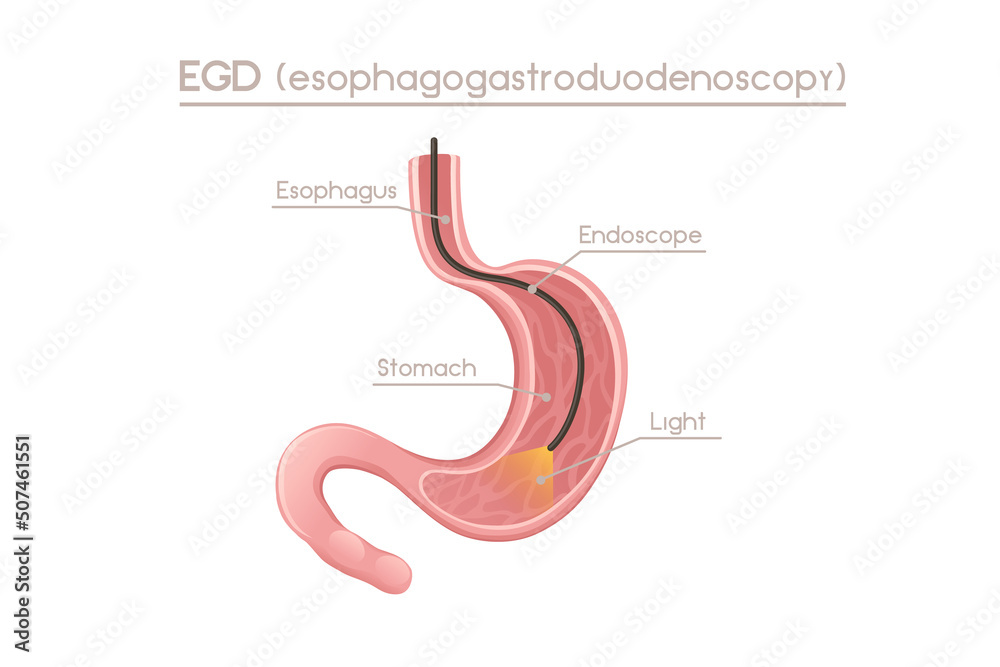 Human Stomach esophagogastroduodenoscopy cartoon design human anatomy ...