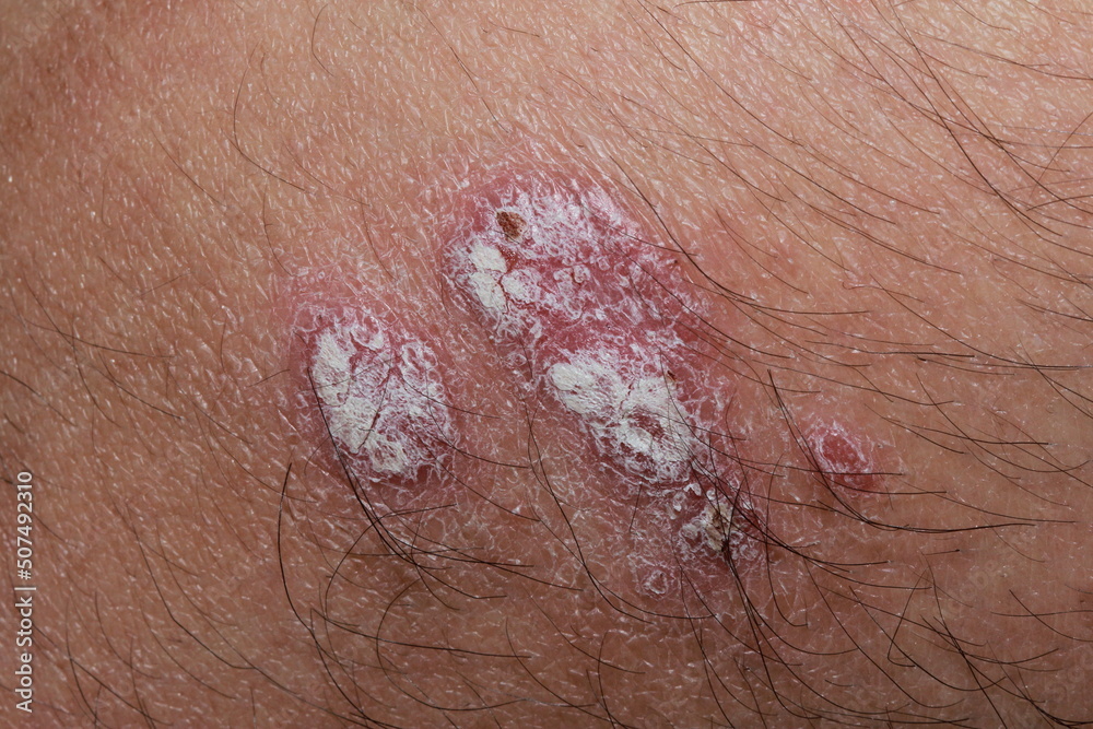 problem skin psoriasis on the body. Psoriasis is an autoimmune disease ...