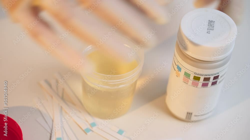 A close-up of a medical laboratory scientist diagnosing of ketonuria by ...