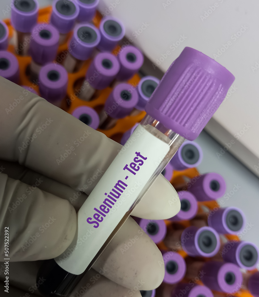 Blood sample for Selenium test, to determine a selenium deficiency or ...