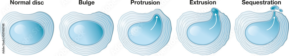 Herniated disc schema. Normal disc. Bulge. Protrusion. Extrusion ...