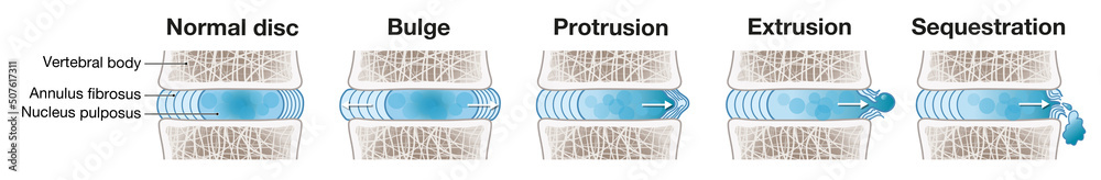 Herniated disc schema. Normal disc. Bulge. Protrusion. Extrusion ...