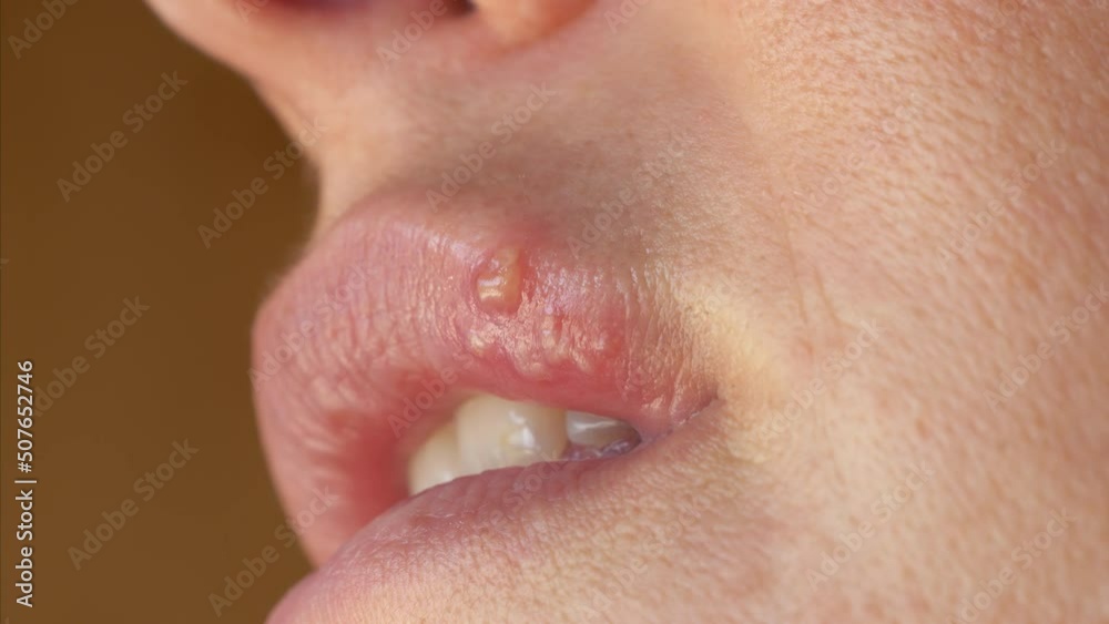 CLOSE UP: Detail view of upper lip affected with blister caused by herpes simplex. Part of a ...