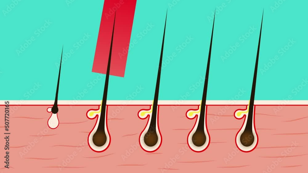 Removing body hair from the hair root by using laser treatment 4K ...