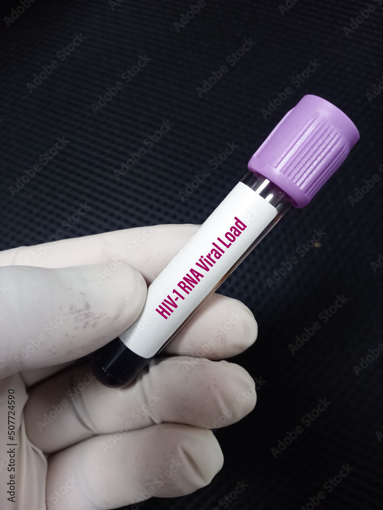 Foto de Blood sample for HIV-1 RNA viral load test. patients known HIV ... Foto de Blood sample for HIV-1 RNA viral load test. patients known HIV ...