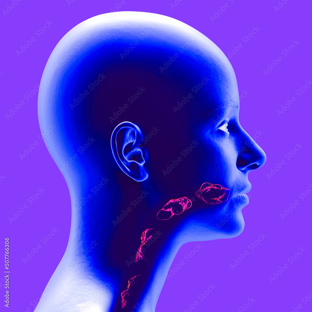 Esophageal Dysphagia
