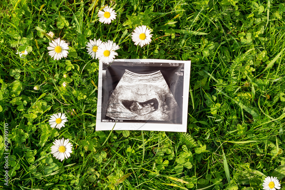 Ultrasound image pregnant baby photo. Ultrasound pregnancy picture on ...
