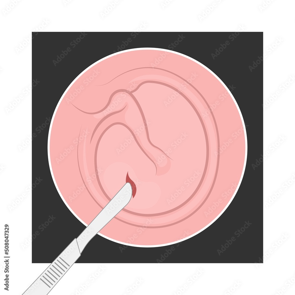 Vecteur Stock Perforated eardrum tube surgical drain Otitis media ear ...